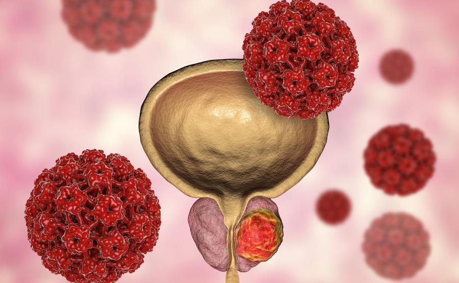 Zachorowalność na raka prostaty w ciągu 30 lat wzrosła 7-krotnie i ...
